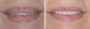 Cheiloplasty Lip Reduction: The Solution to Overly Large Lips