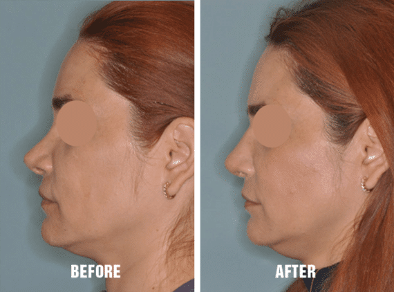 Repairing The "Scooped Nose" | Dr. Anthony Bared