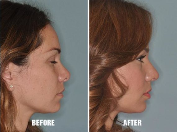 Revision Rhinoplasty Photos | Miami, FL | Patient 792