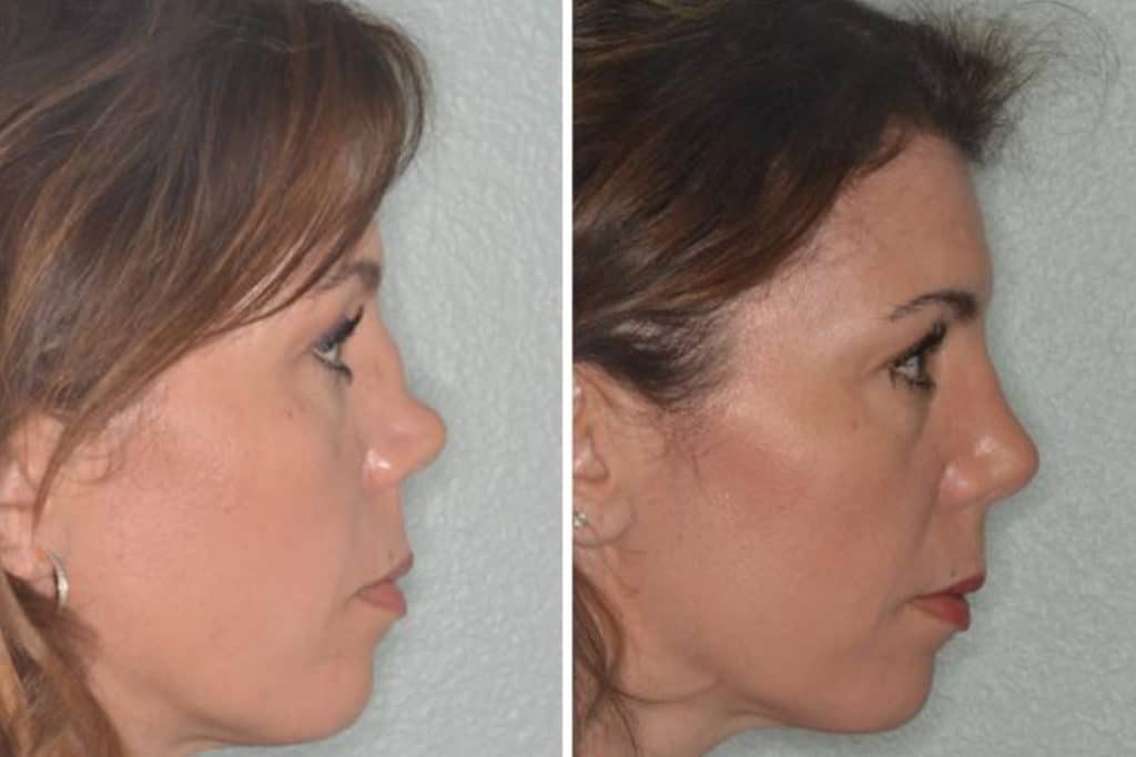Revision Nose Job Rib Cartilage | Dr. Anthony Bared