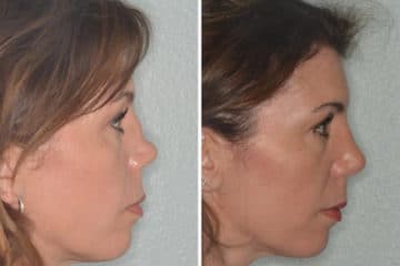 Revision Nose Job Rib Cartilage | Dr. Anthony Bared