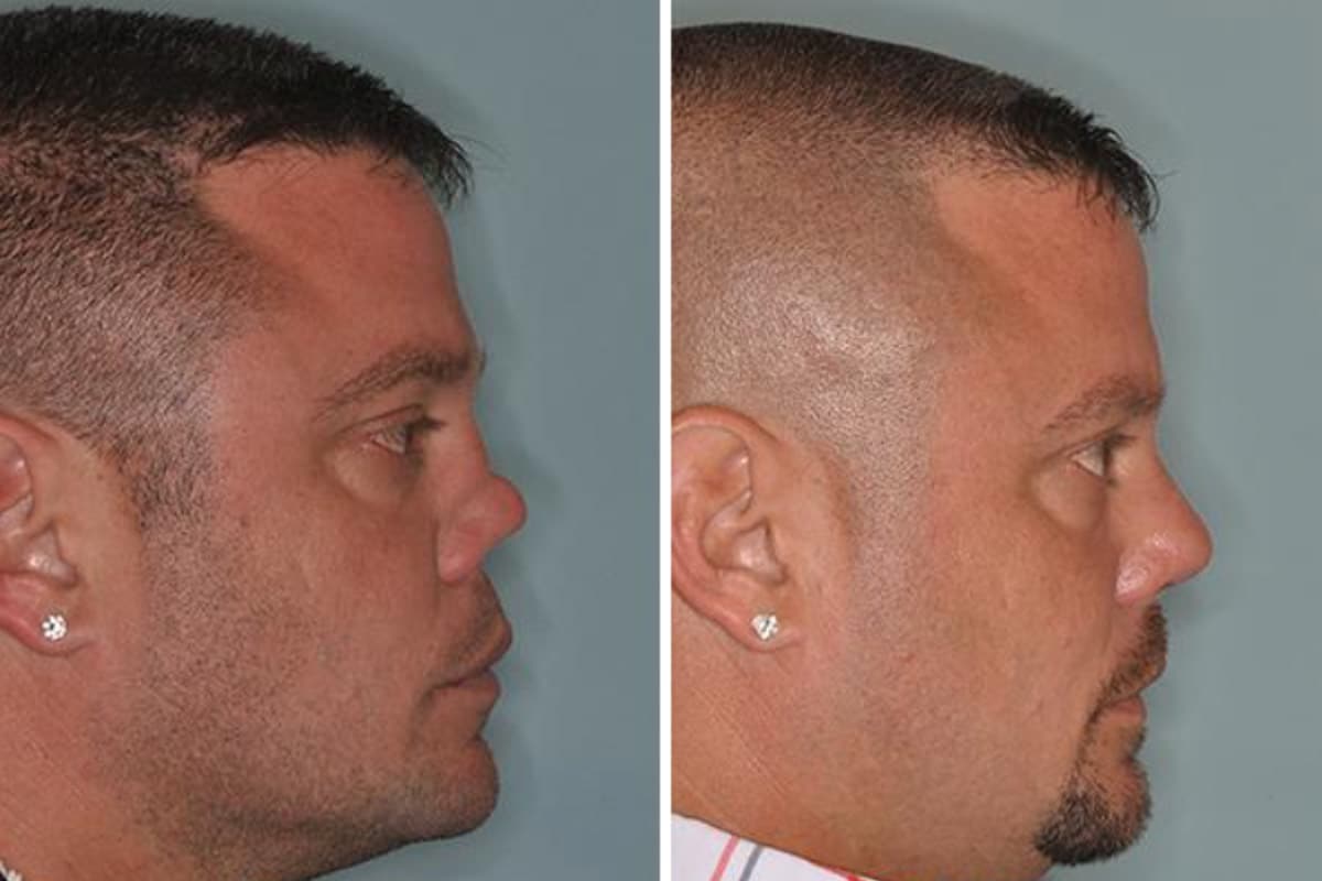 Rib Cartilage: Pros & Cons | Dr. Anthony Bared, M.D - Facial Plastic ...