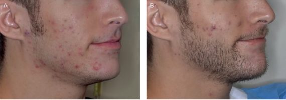 FTM Trans Beard Transplants | Dr. Anthony Bared