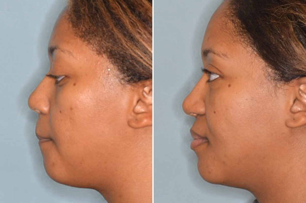 Nose Job Before And After Profile