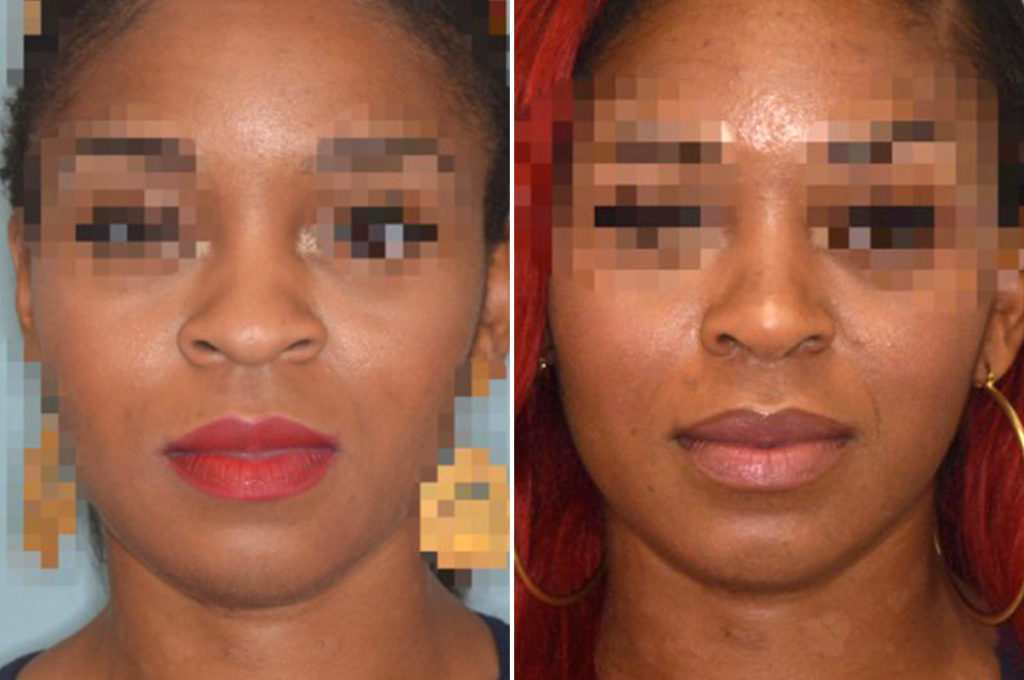 Ethnic Rhinoplasty Photos | Miami, FL | Patient 1035
