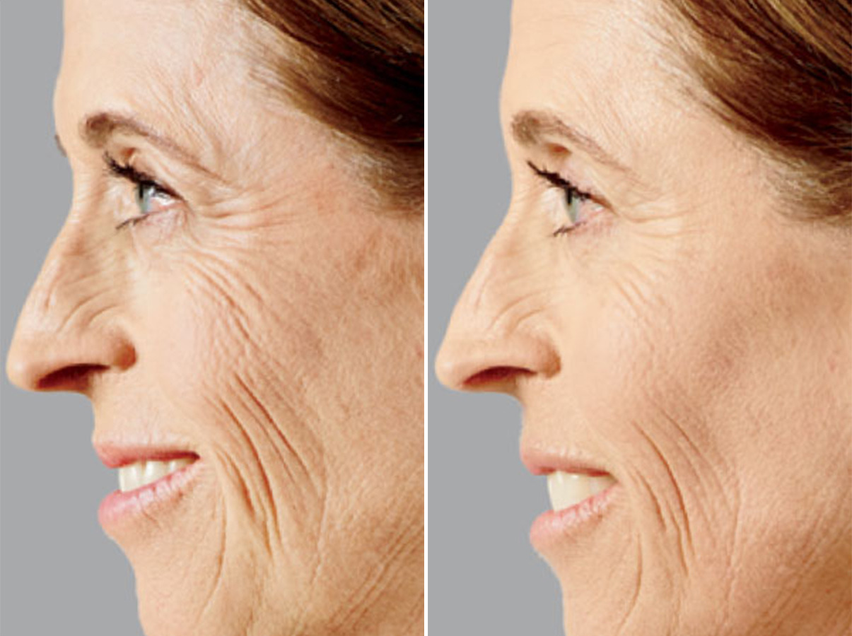 Voluma Photos - Dr. Anthony Bared, M.D - Facial Plastic Surgeon