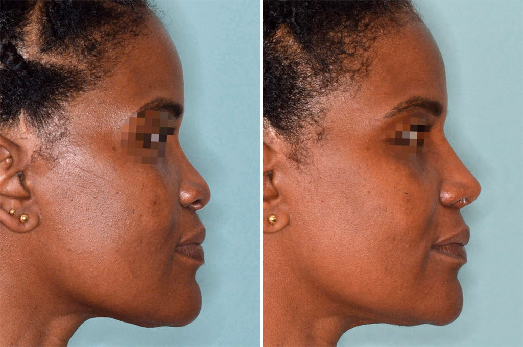 Ethnic Rhinoplasty Photos | Miami, FL | Patient 4612