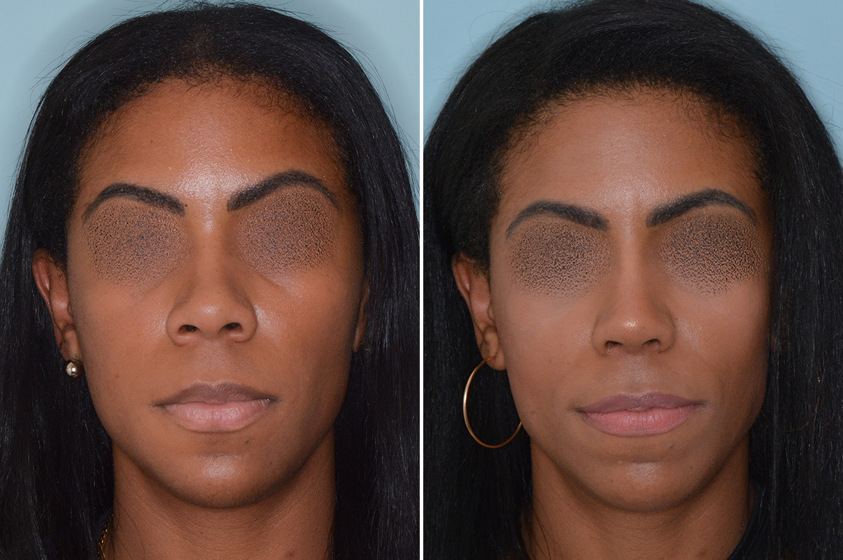 Ethnic Rhinoplasty Photos | Miami, FL | Patient 3773