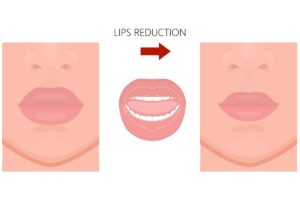 Cheiloplasty Lip Reduction: The Solution to Overly Large Lips