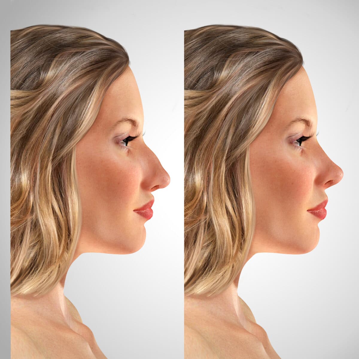 Dorsal Refinement | Dr. Anthony Bared | Facial Plastic Surgeon