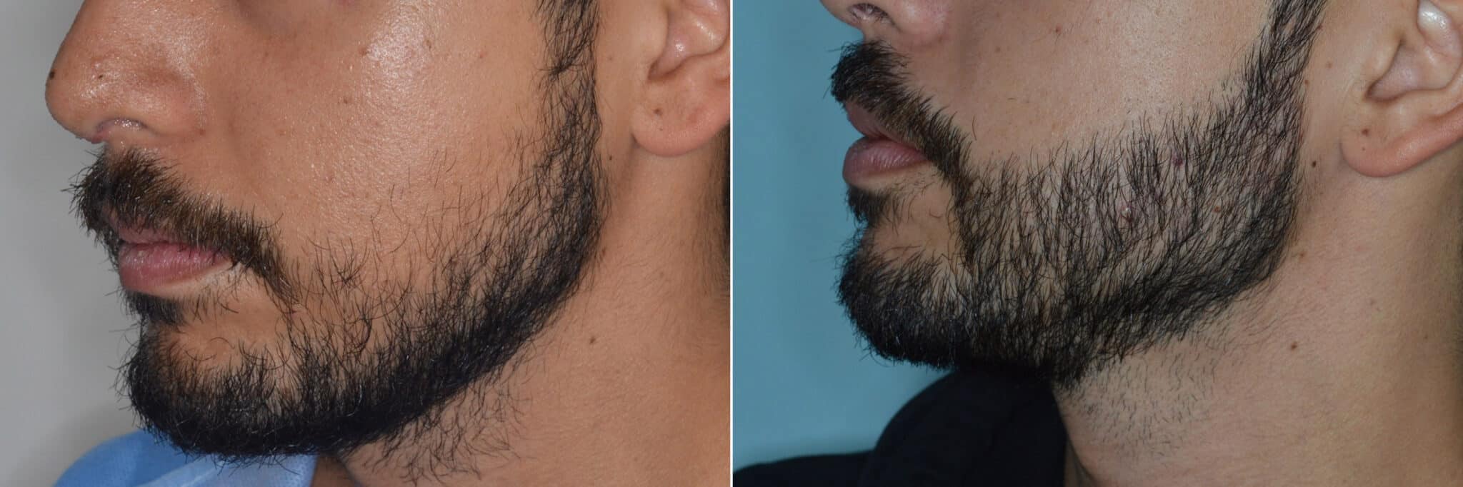 Beard Transplant Photos | Miami, FL | Patient 3272