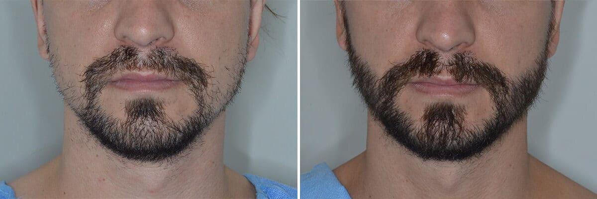 Beard Transplant Aftercare: How to Care for Your New Facial Hair