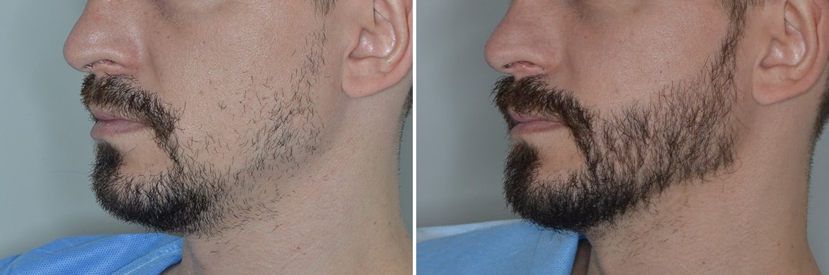 Beard Transplant Photos | Miami, FL | Patient 6956