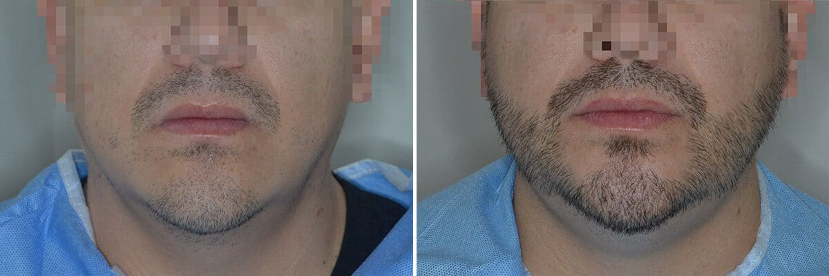 Beard Transplant Photos - Dr. Anthony Bared, M.D - Facial Plastic Surgeon