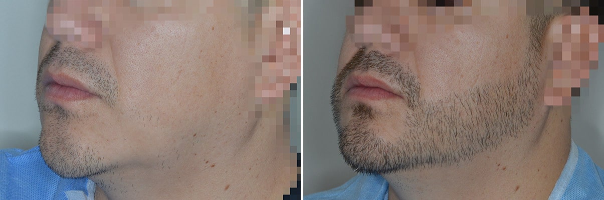 Beard Transplant Photos | Miami, FL | Patient 7118