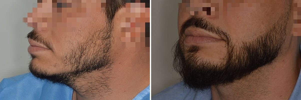 Beard Transplant Photos | Miami, FL | Patient 7491