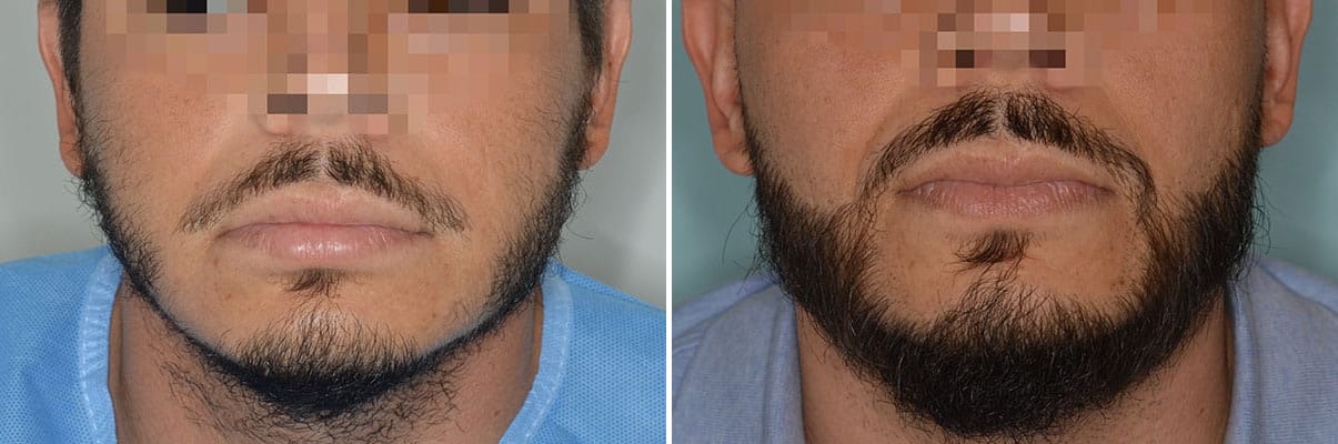 Beard Transplant Photos - Dr. Anthony Bared, M.D - Facial Plastic Surgeon