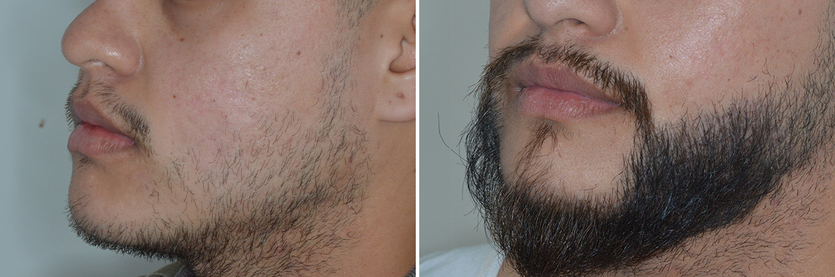 Beard Transplant Photos | Miami, FL | Patient 6723