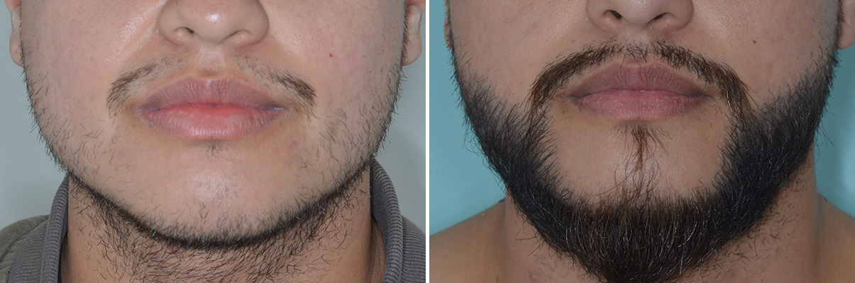 Beard Transplant Guide: Achieve Fuller, Thicker Beard