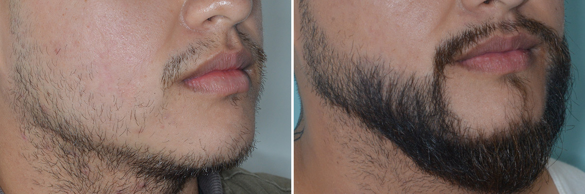 Beard Transplant Photos | Miami, FL | Patient 6723