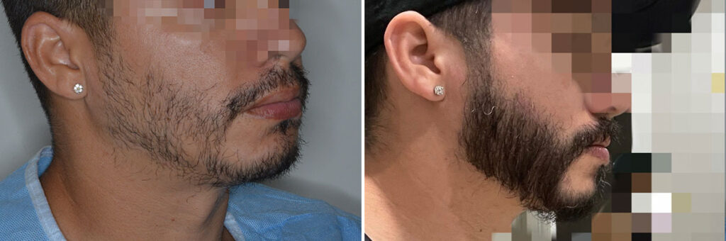 Beard Transplant Photos | Miami, FL | Patient 7994