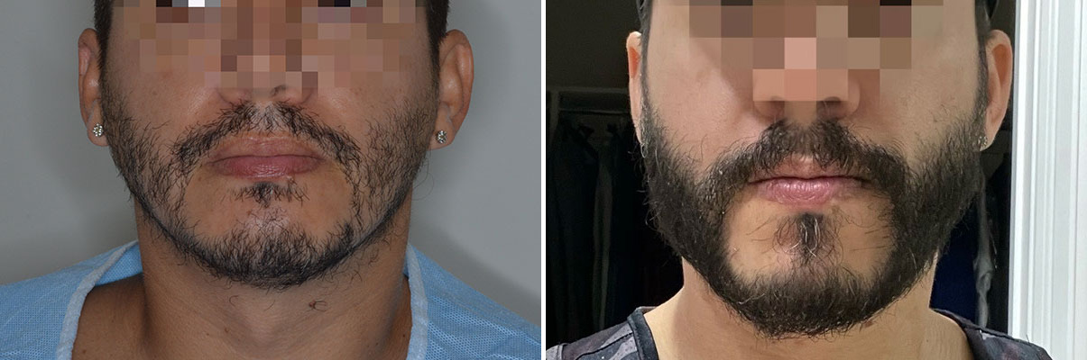 Beard Transplant Photos - Dr. Anthony Bared, M.D - Facial Plastic Surgeon