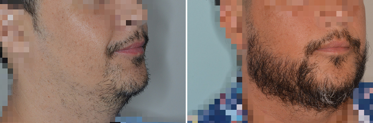 Beard Transplant Photos | Miami, FL | Patient 8058