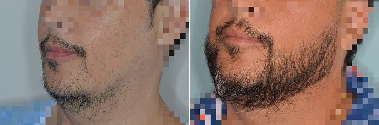 Beard Transplant Photos | Miami, FL | Patient 8058