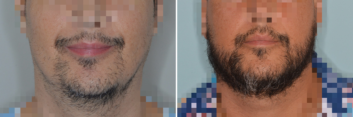 Beard Transplant Photos - Dr. Anthony Bared, M.D - Facial Plastic Surgeon